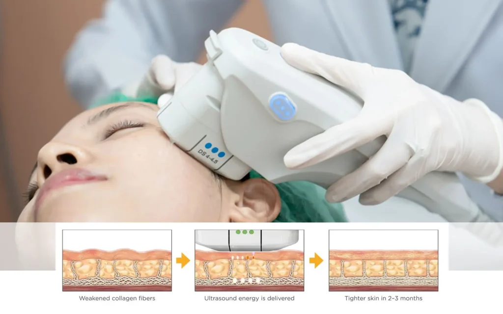Ultherapy Prime - Aura Aesthetics