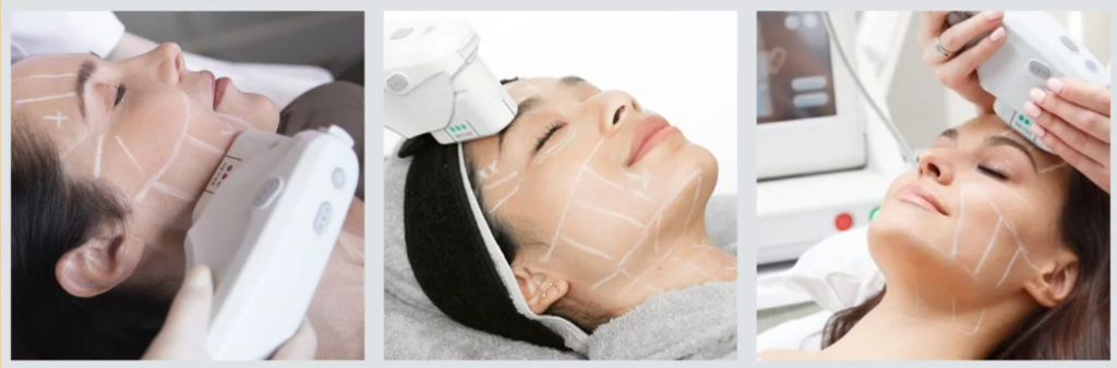 Ultherapy Prime - Aura Aesthetics